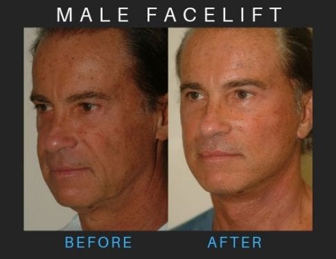 How Can Facelift Surgery Help Men? - Beverly Hills, CA | The Male Face Lift